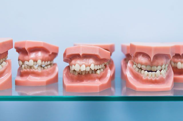Malocclusion of the Teeth: Symptoms, Cause, and Treatment