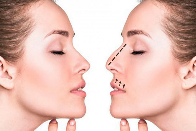 Indications for Rhinoplasty and Methods of Nose Surgery