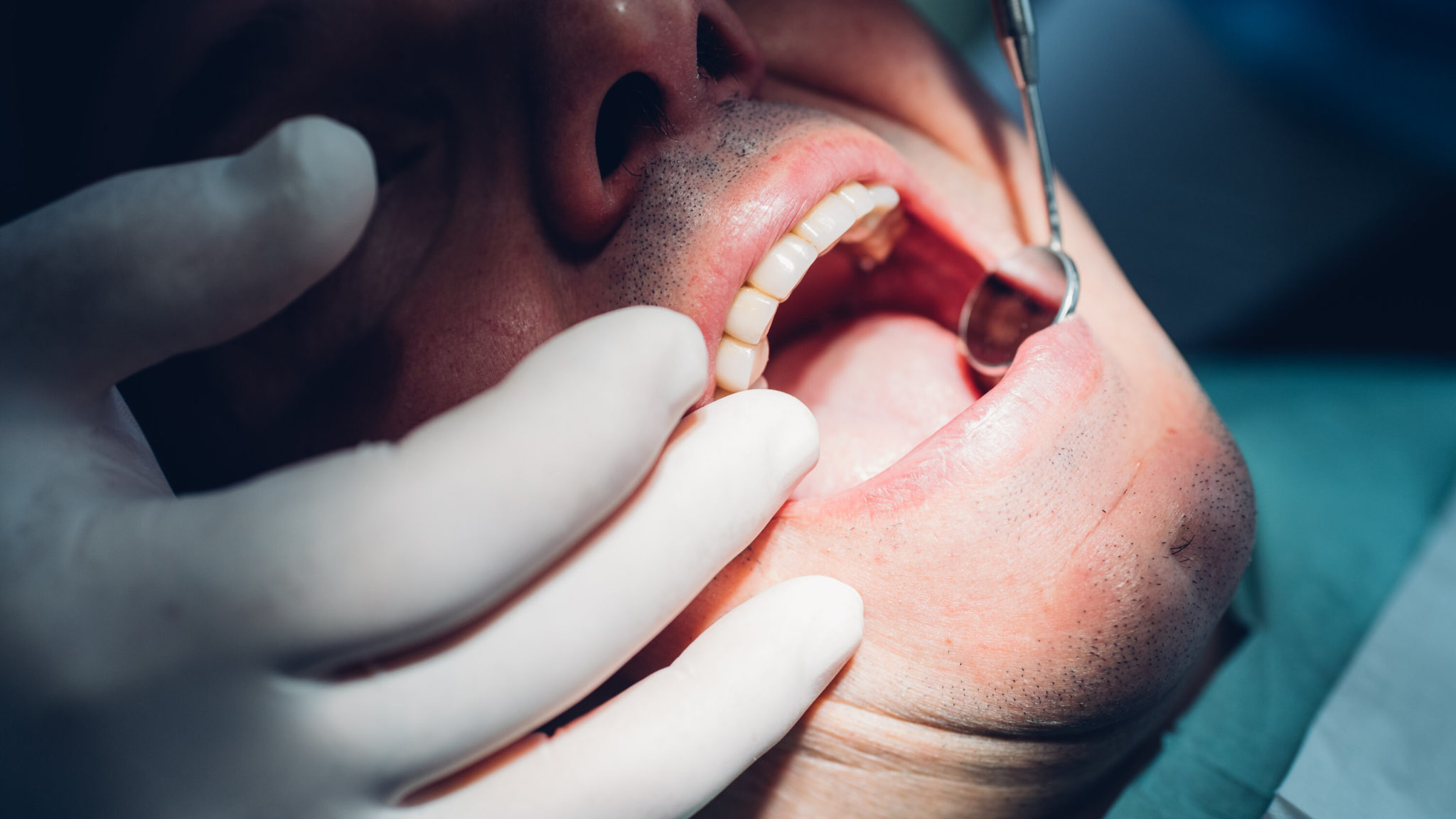 5 Effective Methods How To Recognize The Types of Tooth Cracks