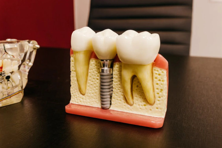 The Procedure of Dental Implants Explained