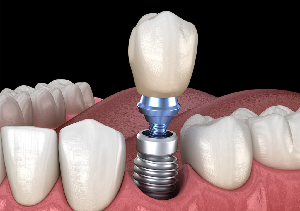 The Benefits of a Single Tooth Implant